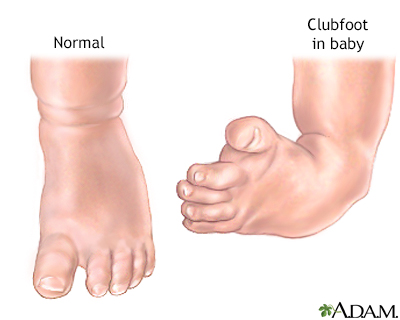 Clubfoot: genetic causes, diagnosis, and treatment | Polygence