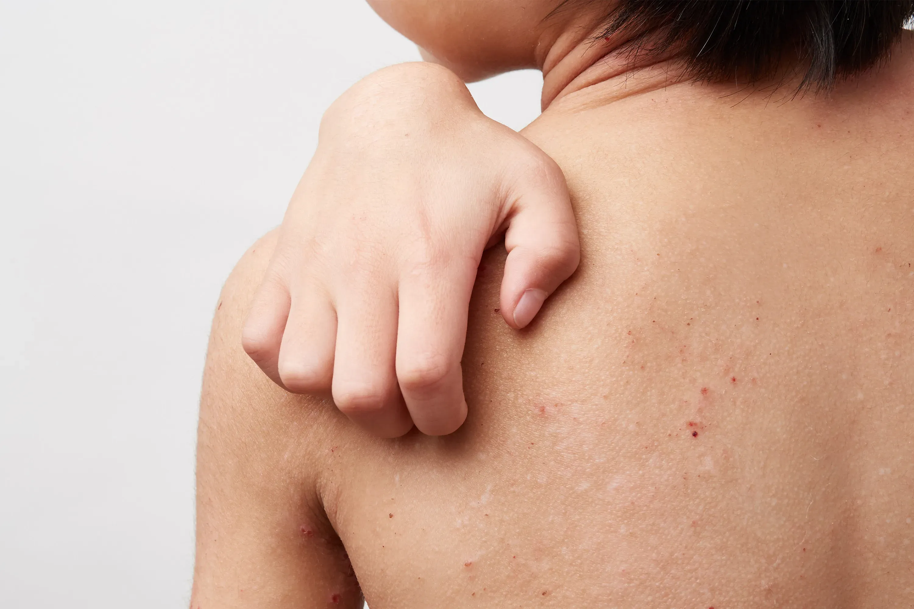 Topical Treatments for Staphylococcus Infections In Juveniles With ...