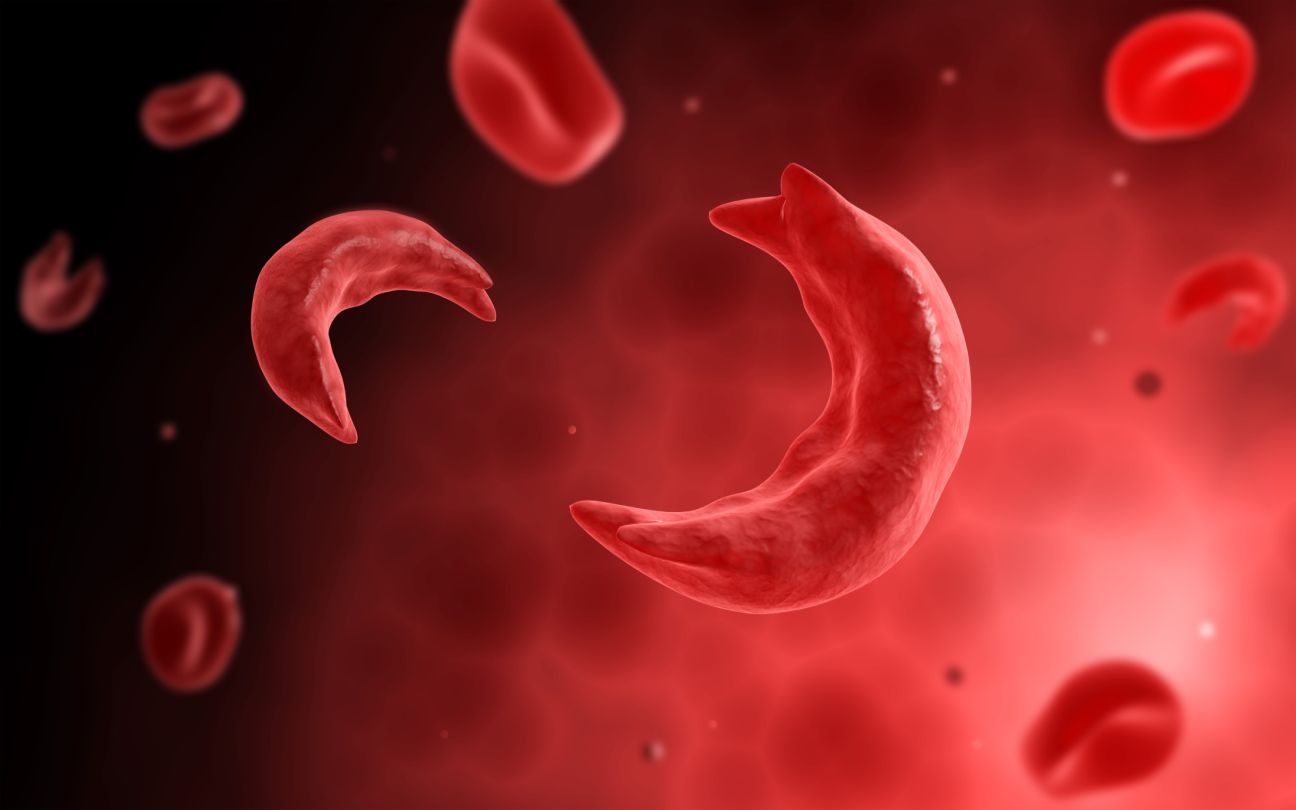 Sickle Cell Anemia: Genetics, Symptoms, and Treatments | Polygence